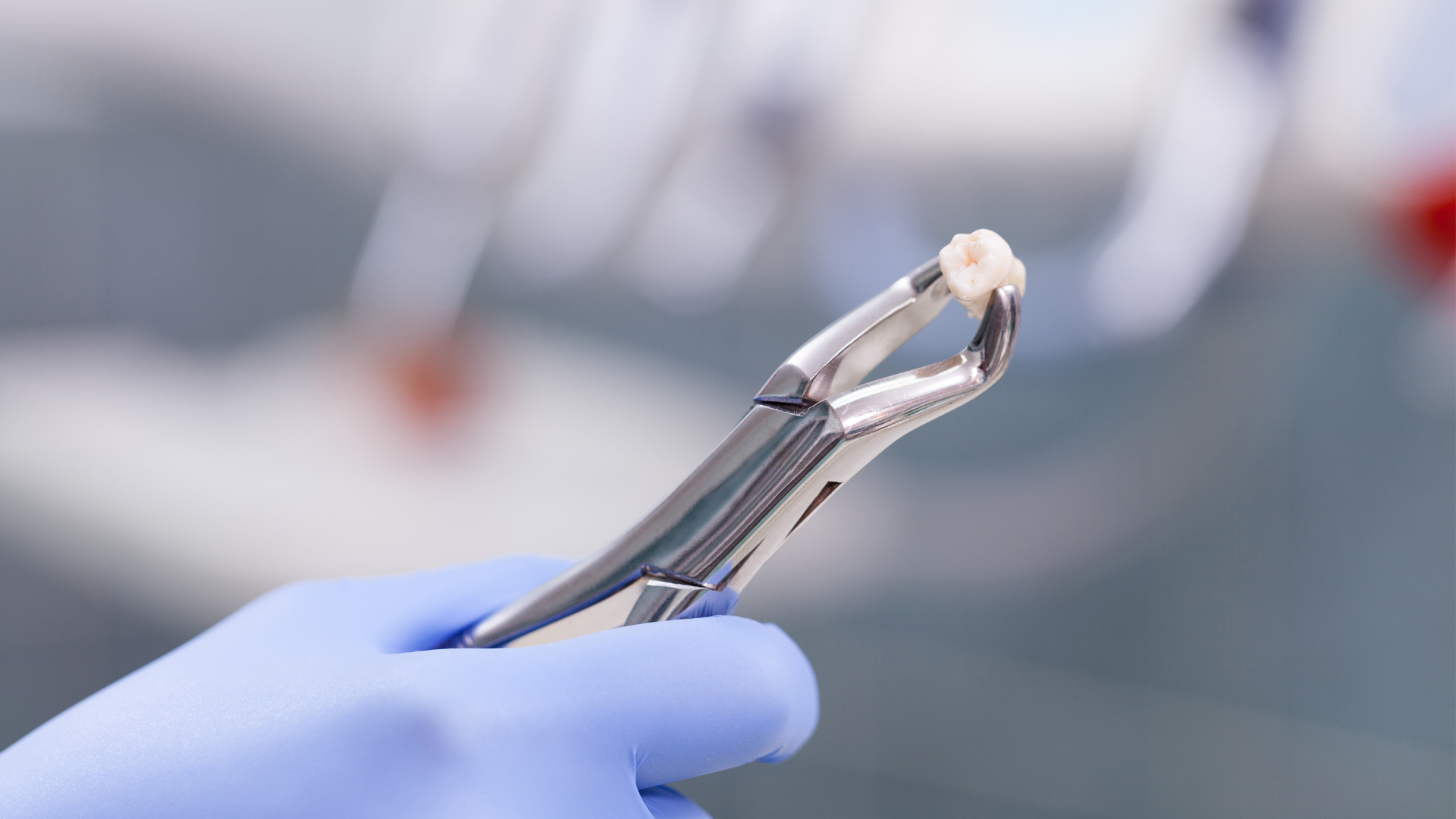 Does a Cracked Tooth Always Need to Be Pulled? - CornerStone Dental